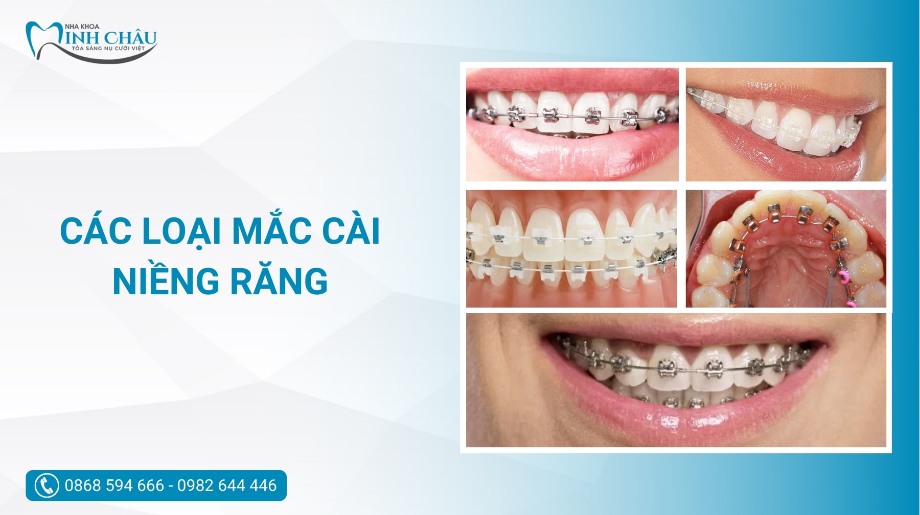 Đâu là các loại mắc cài niềng răng được sử dụng phổ biến nhất hiện tại ...